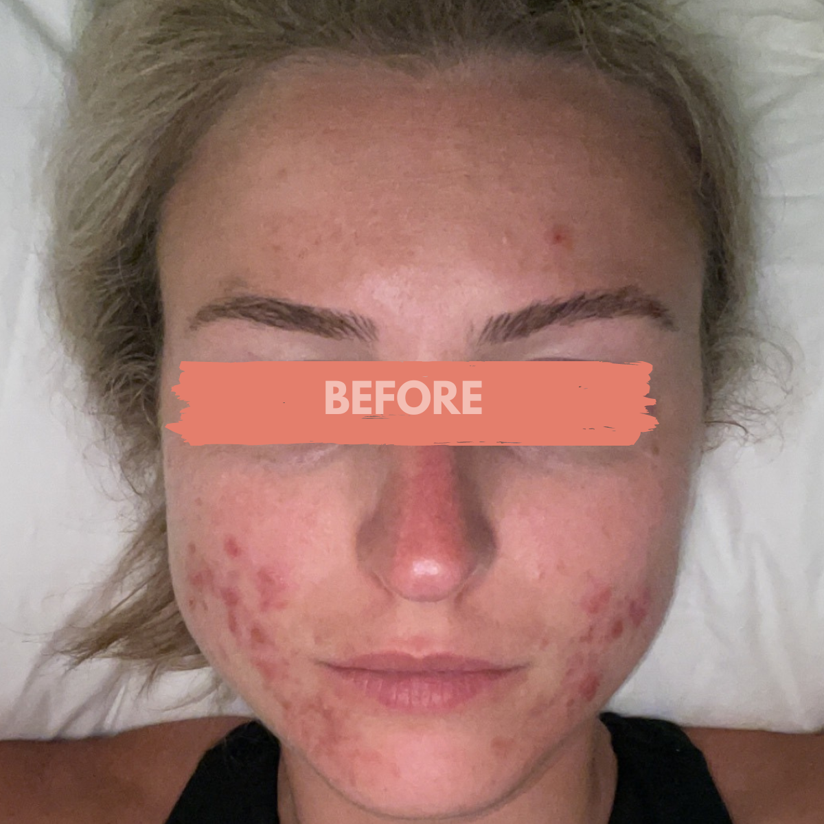 Acne Free Without The Pill Katie Stewart Wellness Reviews 1 Katie