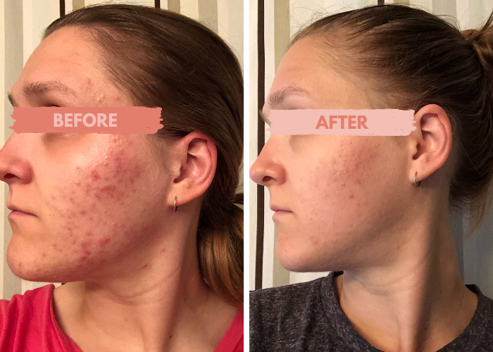 Clear Skin Without Accutane Katie Stewart Wellness Reviews