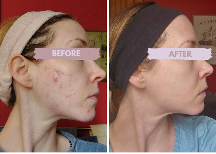 Finding Freedom From Acne Katie Stewart Wellness Reviews Katie