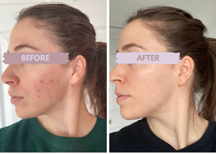 Acne Free After 15 Years Katie Stewart Wellness Reviews Katie