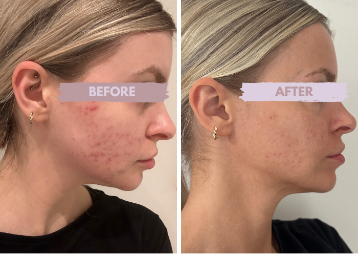 An Acne Victory Katie Stewart Wellness Reviews Katie Stewart Acne