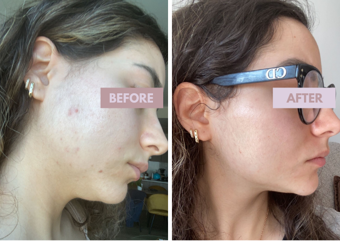 Clear Skin After 15 Years Katie Stewart Wellness Reviews Katie