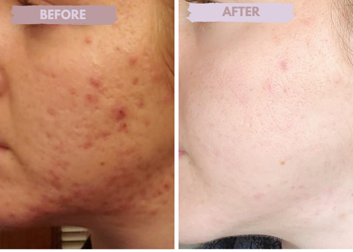 Beckys Clear Skin And Gut Healing Journey Katie Stewart Wellness Reviews